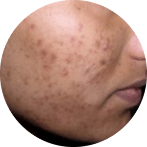 Como tratar e prevenir manchas de sol na pele